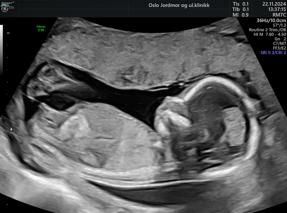 2D ultralyd uke 15-20