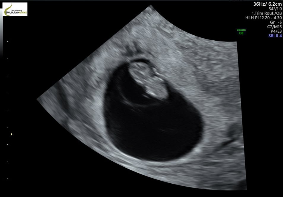 Early ultrasound week 6 - 7